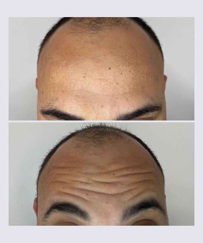 Botox - Sharm - El - Sheikh - Aesthetic - Clinic