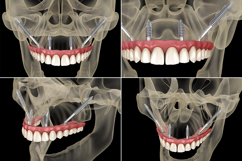 Zygomatic Implants in Izmir, Turkey | Fixed Teeth for Severe Bone Loss